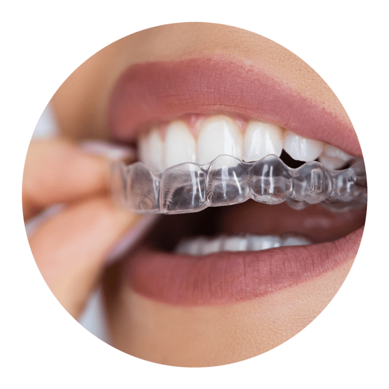 Clear Aligners – Kingshurst Dental Surgery